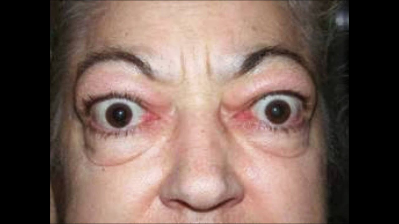 Exoftalmos.wmv - YouTube
