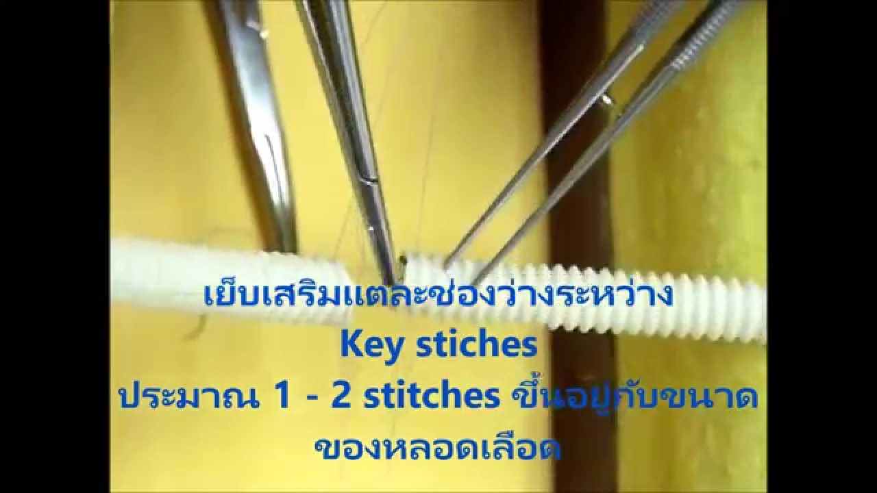 Carrel's Triangulation Vascular Anastomosis - YouTube