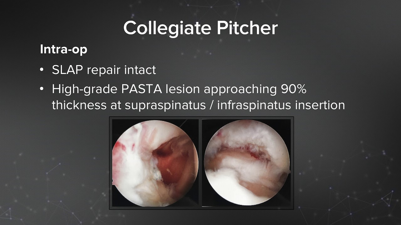 Post-SLAP Repair PASTA Lesion In an Overhead Athlete - YouTube