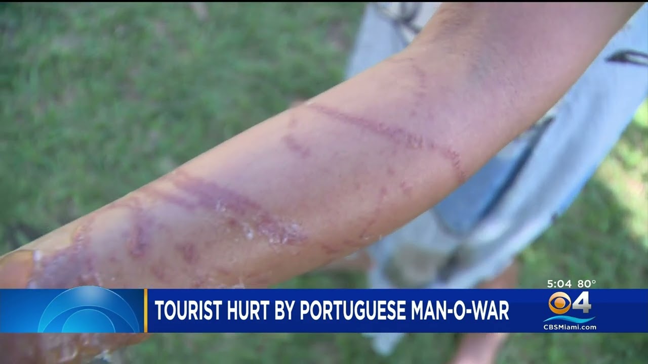 Portuguese Man Of War Sting Scar