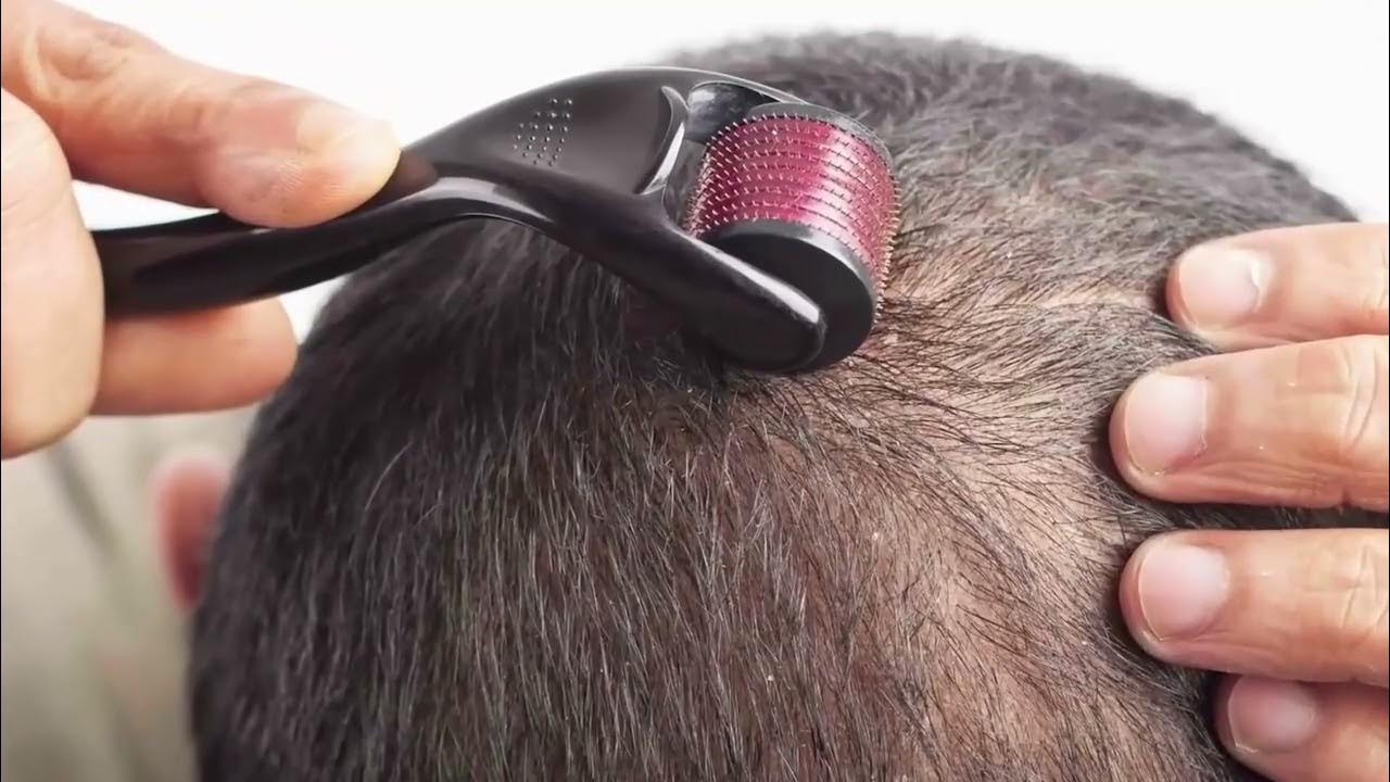Understanding Hair Loss： Causes, Solutions, and Expert Advice - YouTube
