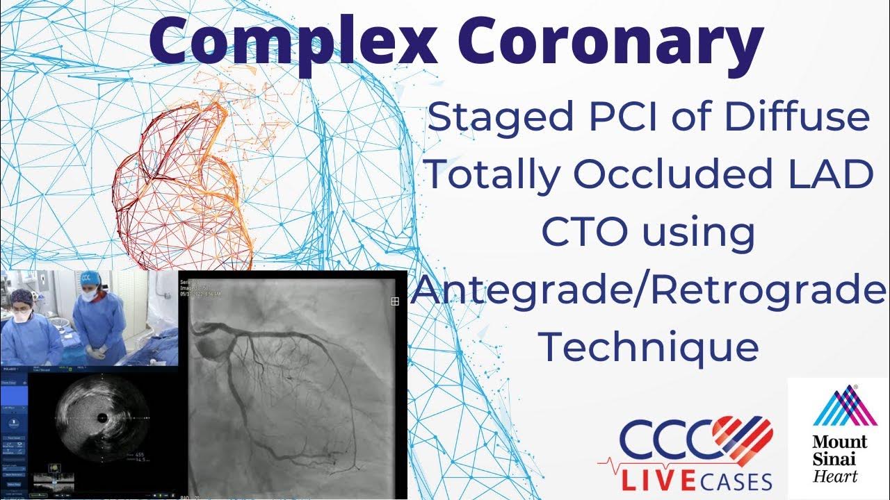 Staged PCI of Diffuse Totally Occluded LAD CTO using Antegrade/Retrograde Technique - YouTube