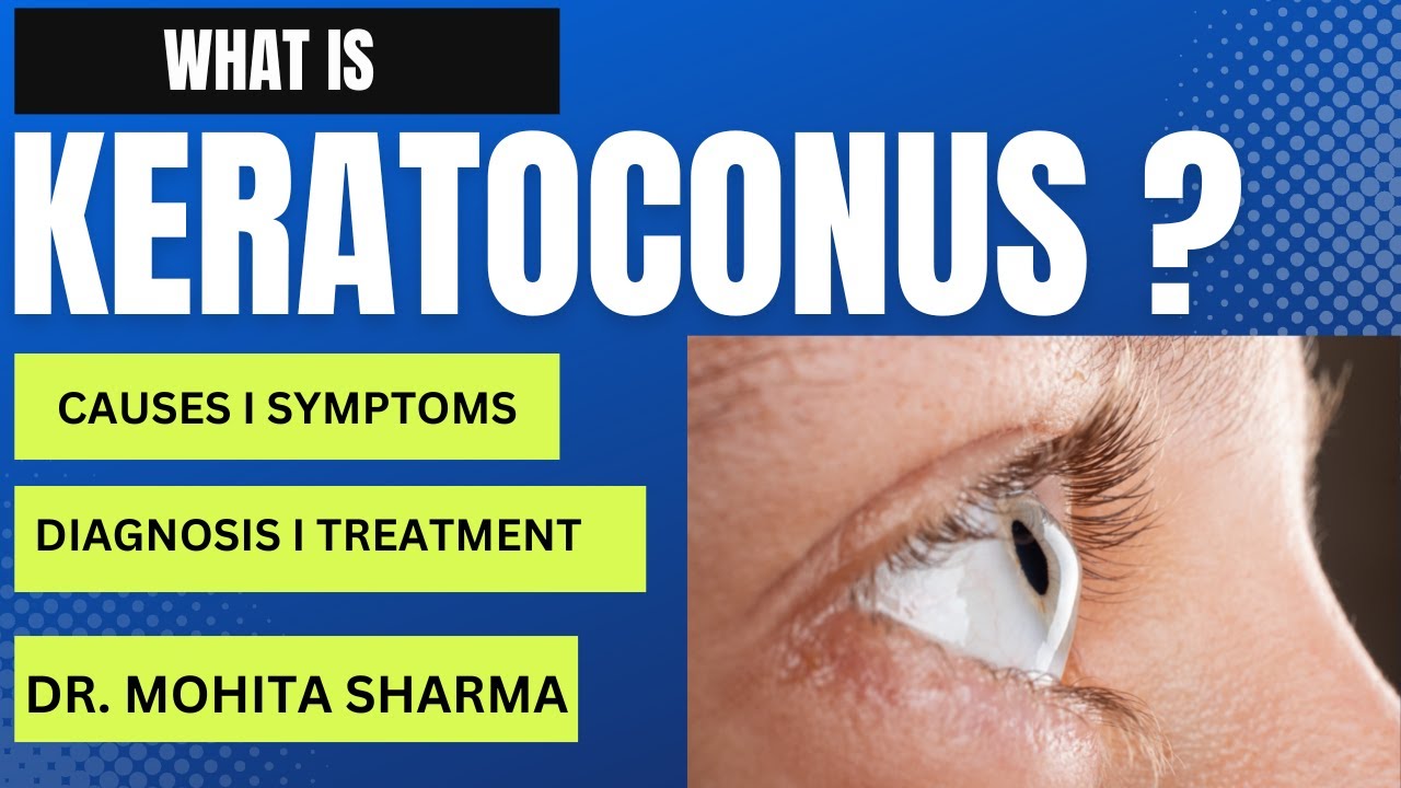 What Is Keratoconus I Causes Symptoms Diagnosis Treatment Youtube