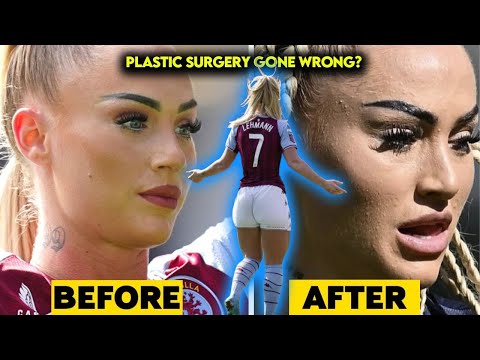 What The Hell HAPPENED to Alisha Lehmann's Face??