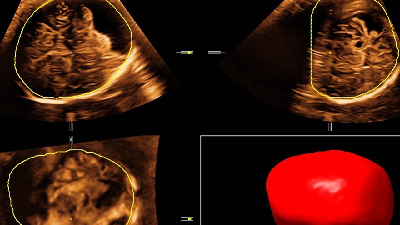 Mega cisterna magna fetal ultrasound 37 wks - YouTube