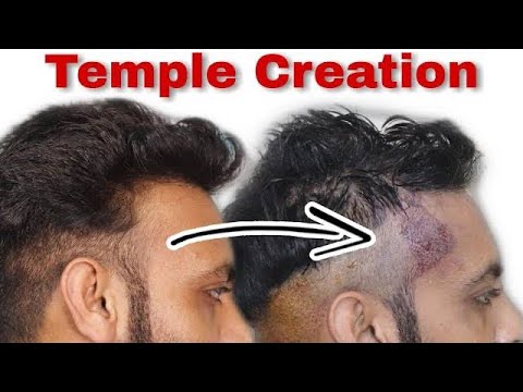 Hair Transplant | Side Angle | Temple#hairfall - YouTube