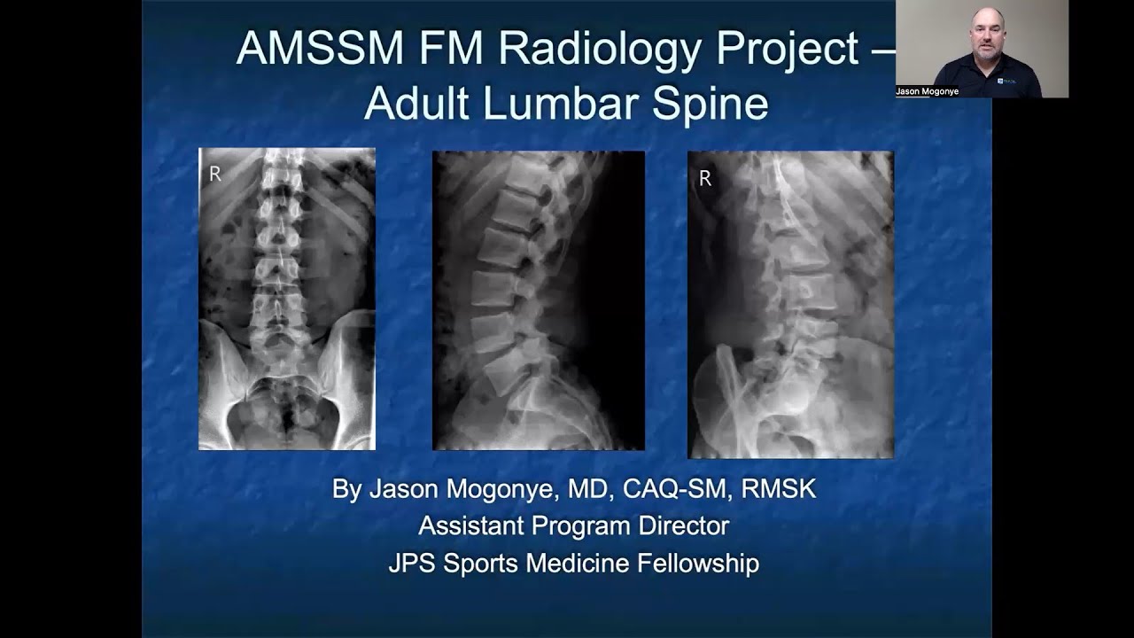Lumbar Spine | MSK Radiology: X-Ray Educational Modules for Primary ...