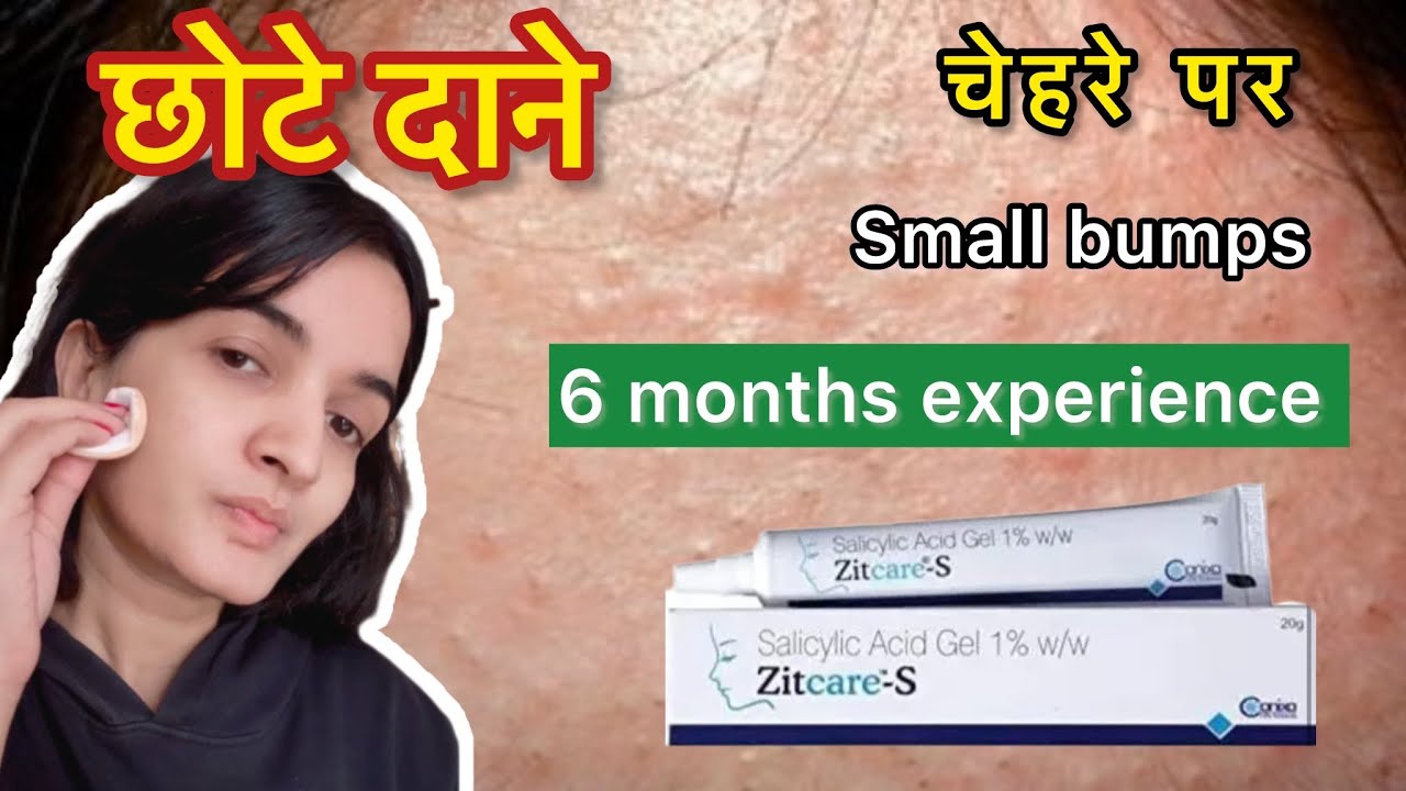 zitcare s gel review | Small pimples on face | छोटे दाने | - YouTube