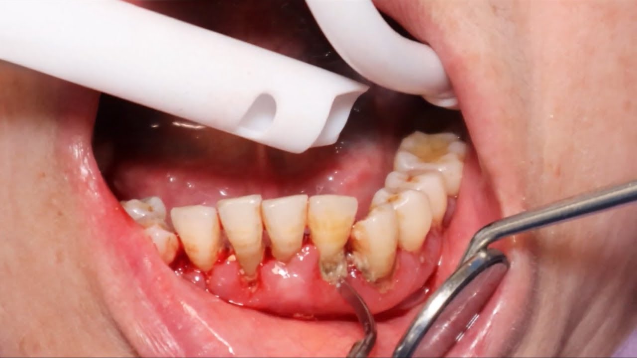 Smokers Teeth Cleaning at Dentist Clinic with Ultrasonic Scaler - YouTube