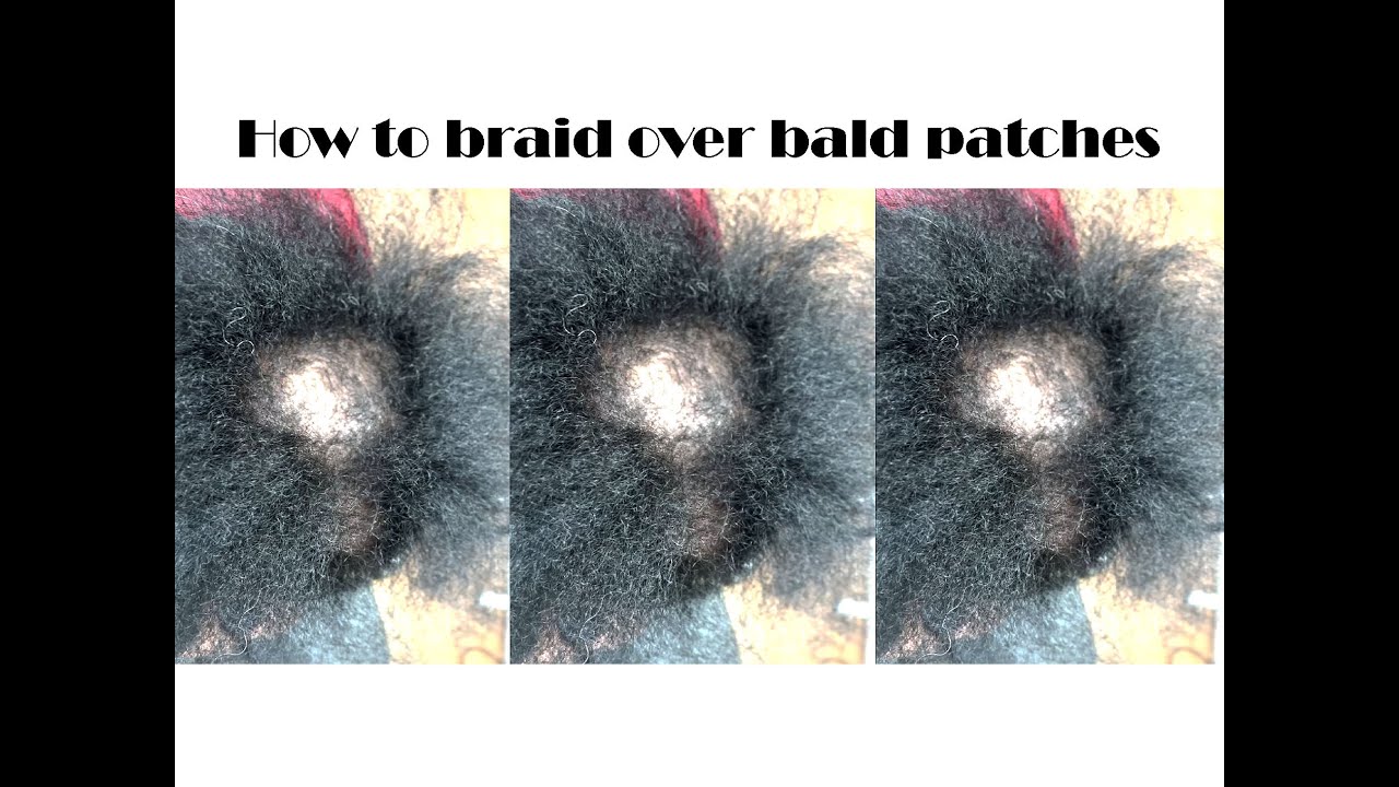 Braids Over Bald Patch | My Grip Game - YouTube
