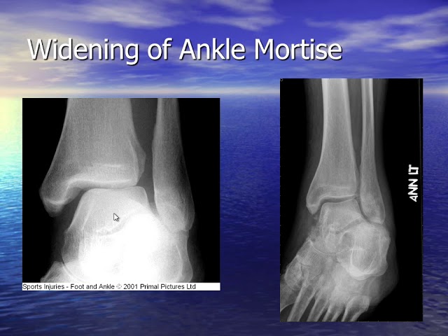Mortise View Management Of Bone Cyst Of Talar Body By Endoscopic