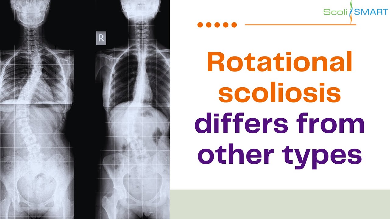 Rotational Scoliosis Explained | How It Differs from Other Scoliosis ...