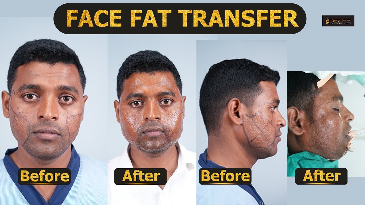 Face Fat Transfer | Acne scar treatment | Face Fat Transfer video - YouTube