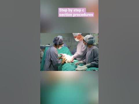 C-section step by step procedure #shorts #cesareandelivery #howto - YouTube