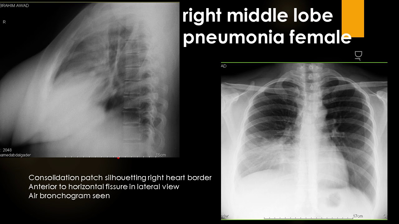 Case 740 Right Middle Lobe Pneumonia Youtube