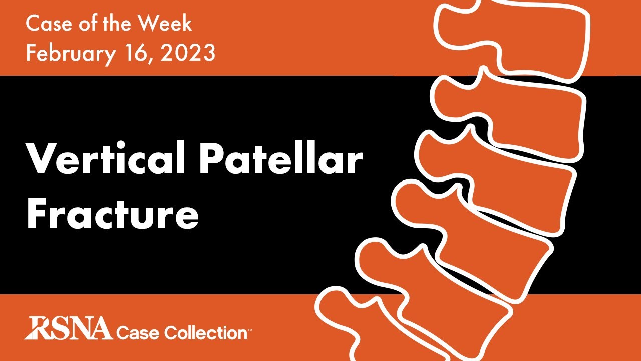 Case of the Week: Vertical Patellar Fracture - YouTube