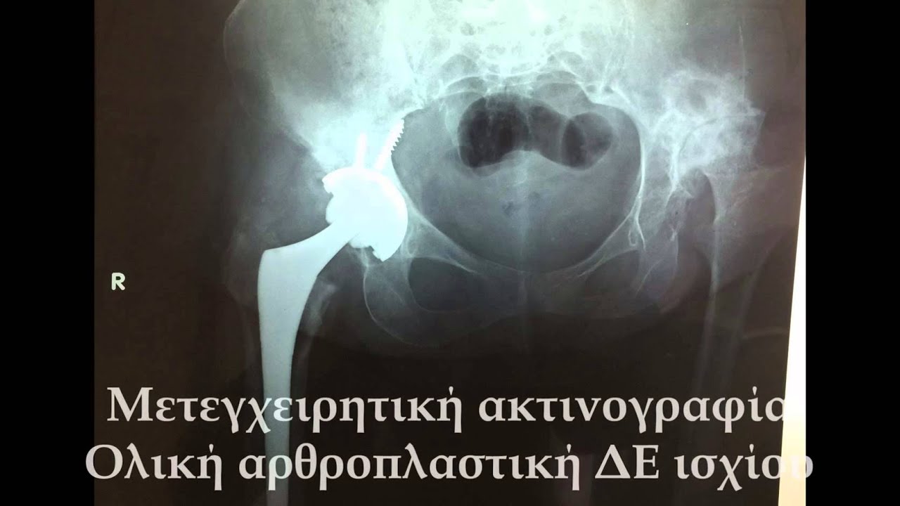 Συγγενές εξάρθρημα ισχίου (αμφο) - Ολική Αρθροπλαστική Ισχίου - Δρ. N ...