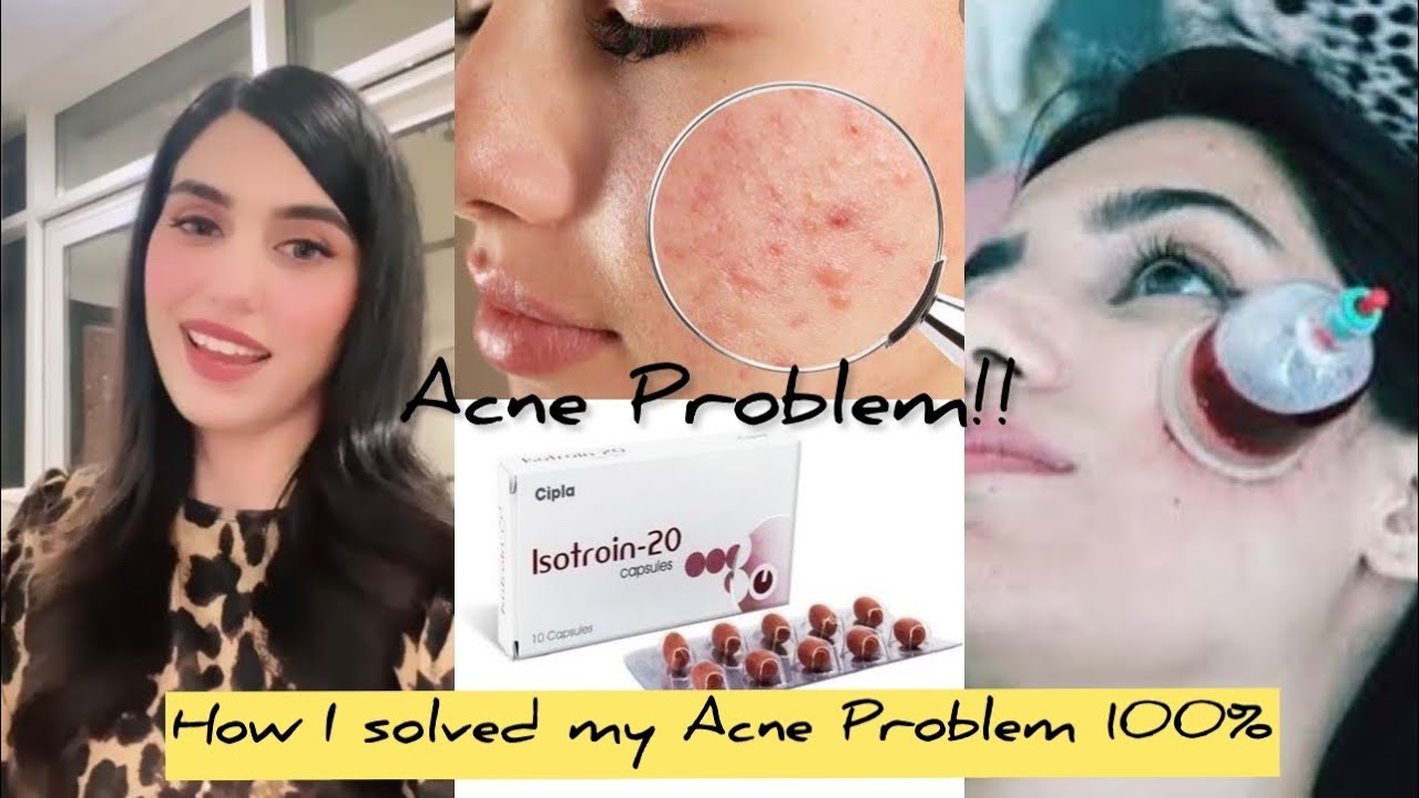 How I clear my Acne 100% | Hajama Vs Isotretnoin (Accutane) - YouTube