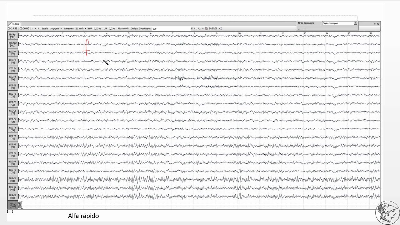064 Oficinas de EEG. Variantes no EEG. alfa rápido e artefatos ...