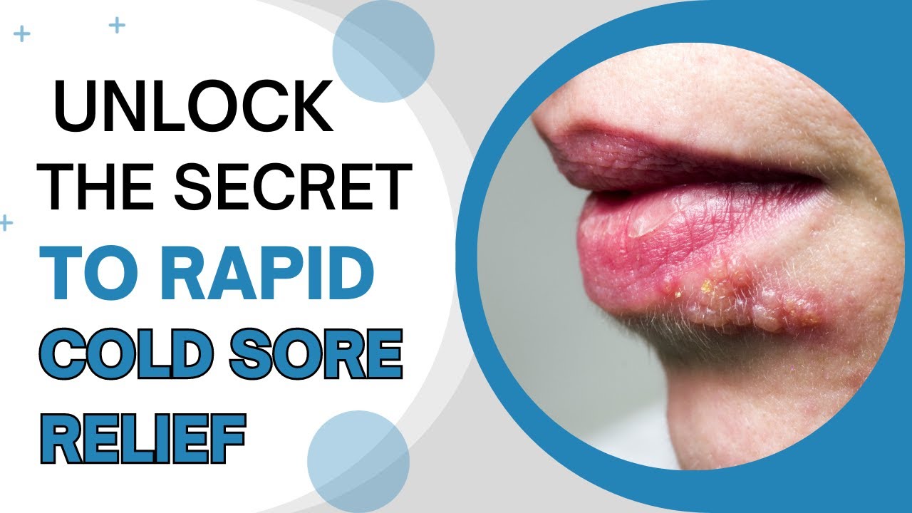 COLD SORES: SYMPTOMS AND HOW TO TREAT - YouTube