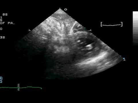 TTE Normal Subcostal Short Axis Pap Muscles Example 1 - YouTube