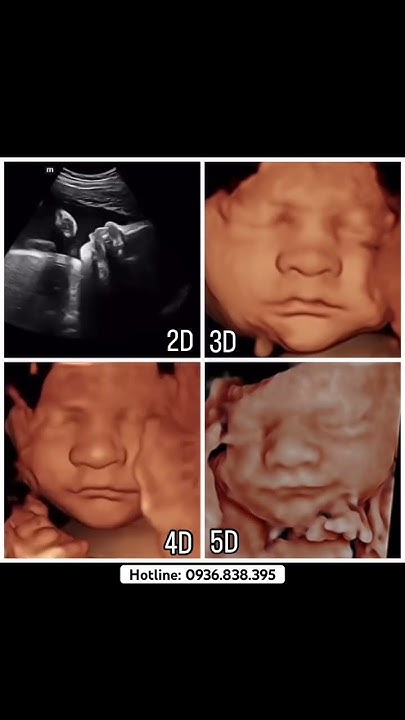 Phân biệt siêu âm 2D, 3D, 4D và 5D trên máy siêu âm Mindray - Hotline: 0936.838.395 - YouTube