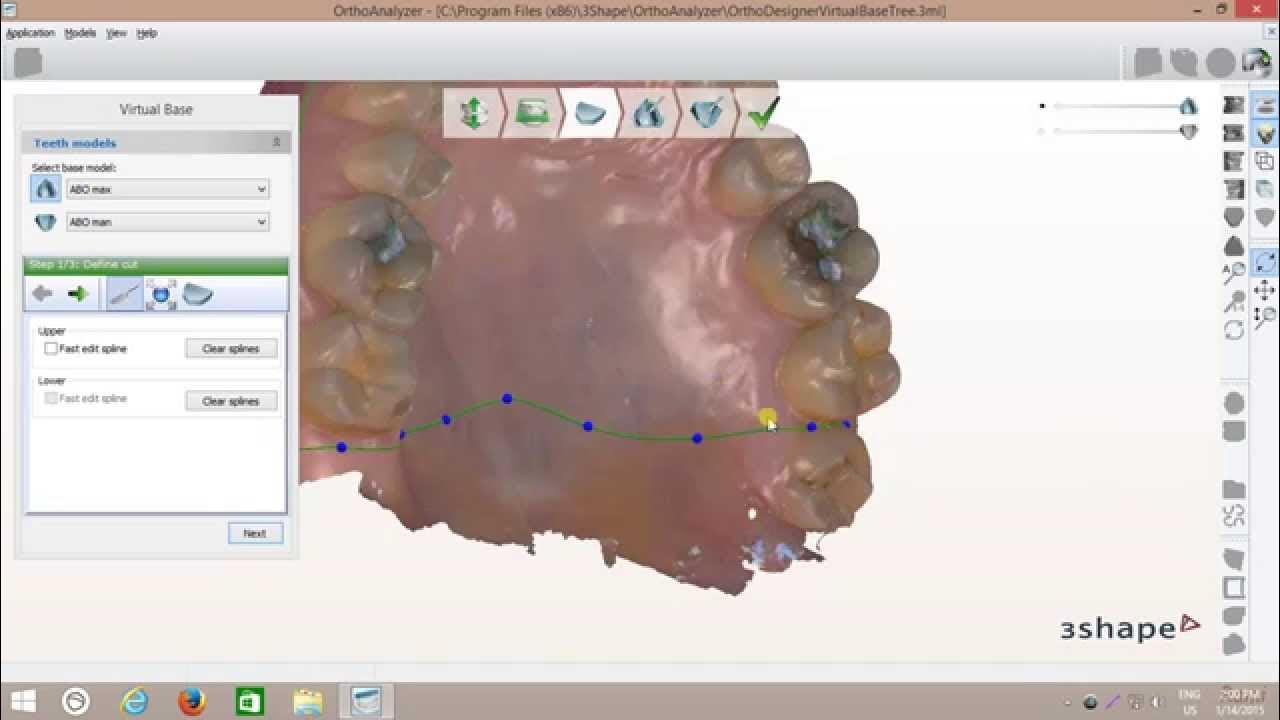 How to prepare Virtual Model Bases in 3Shape Ortho Analyzer 2013 P3 - YouTube