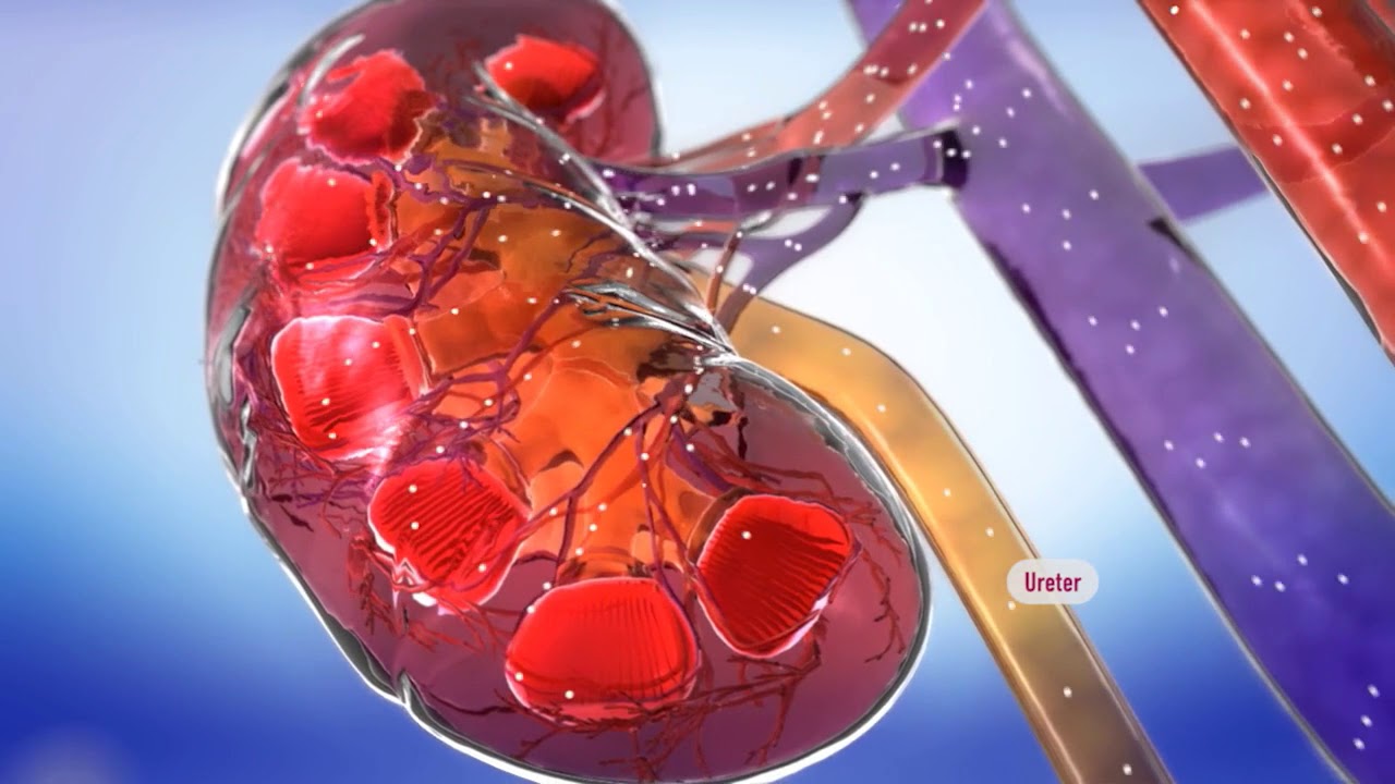 Hiperfosforemia Nefralia® - YouTube