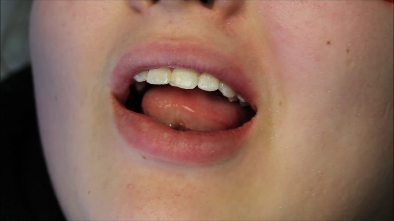 Using a Finishing Bur to Clean Bracket Residue - YouTube