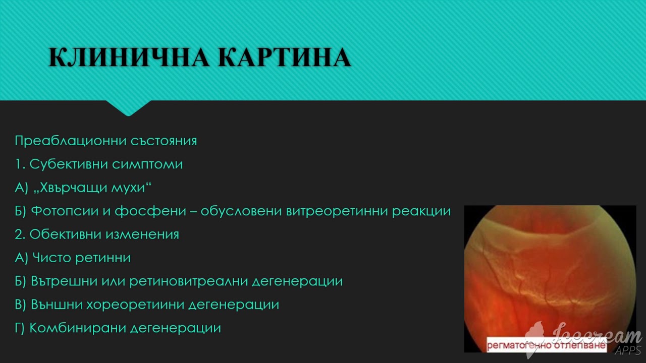 Регматогенно отлепване на ретината Youtube