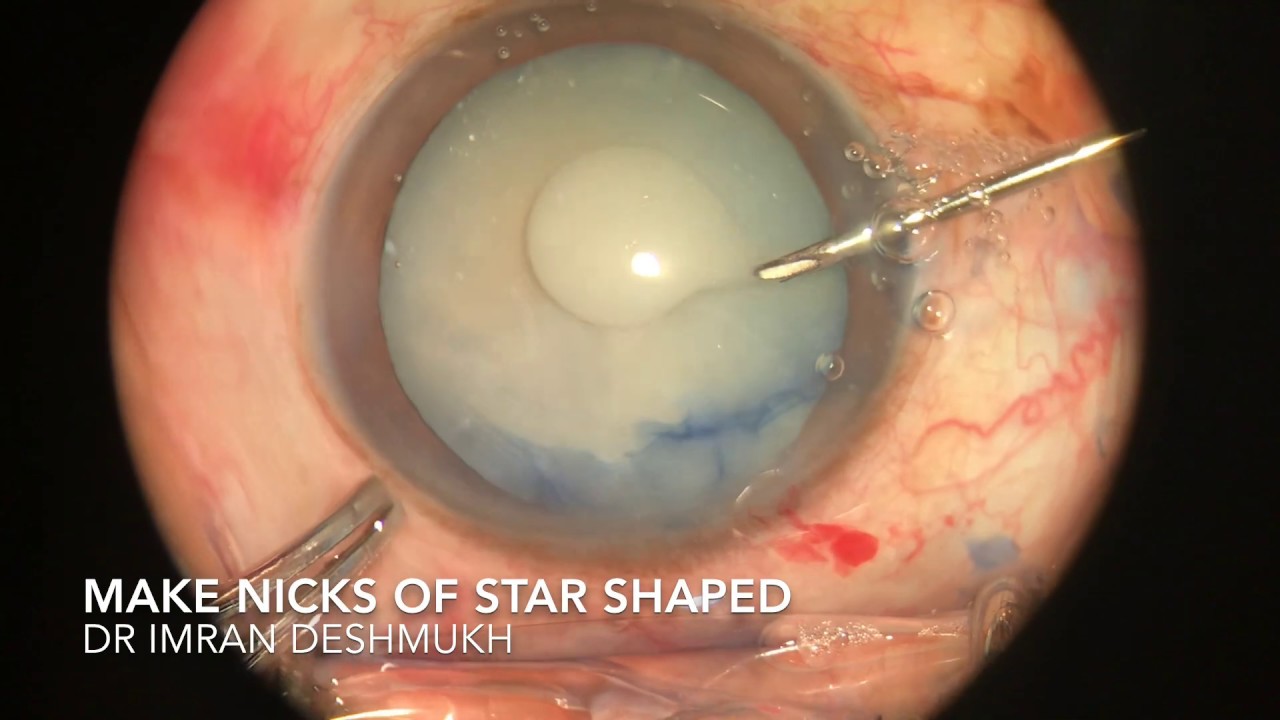 “Rhexis” in Intumescent (Milky) Cataract - YouTube