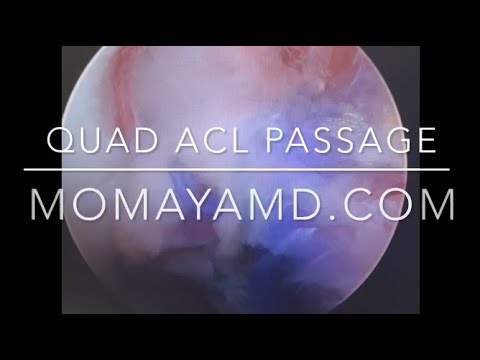 Quad Tendon ACL Graft Passage - YouTube