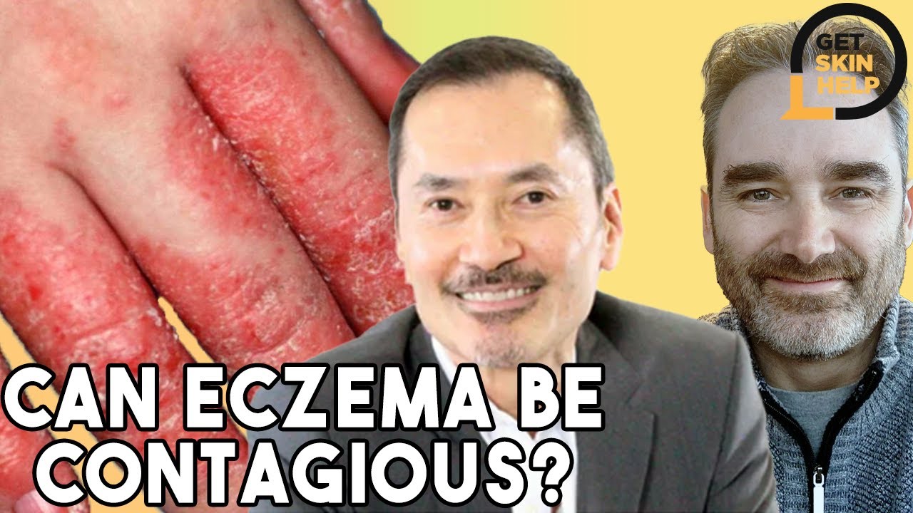 ECZEMA & CONTACT DERMATITIS Can be Contagious?? | Podcast Snippet - YouTube