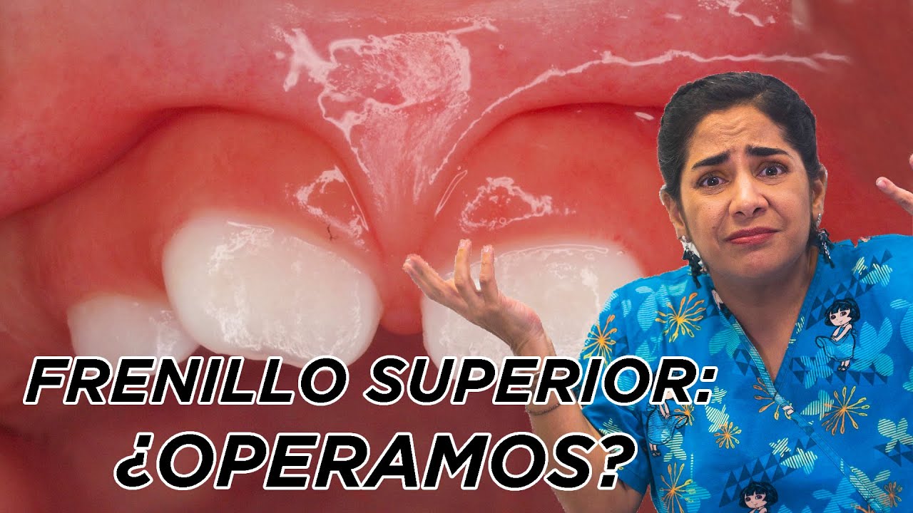 CASO REAL: ¿Se opera el frenillo superior? - YouTube
