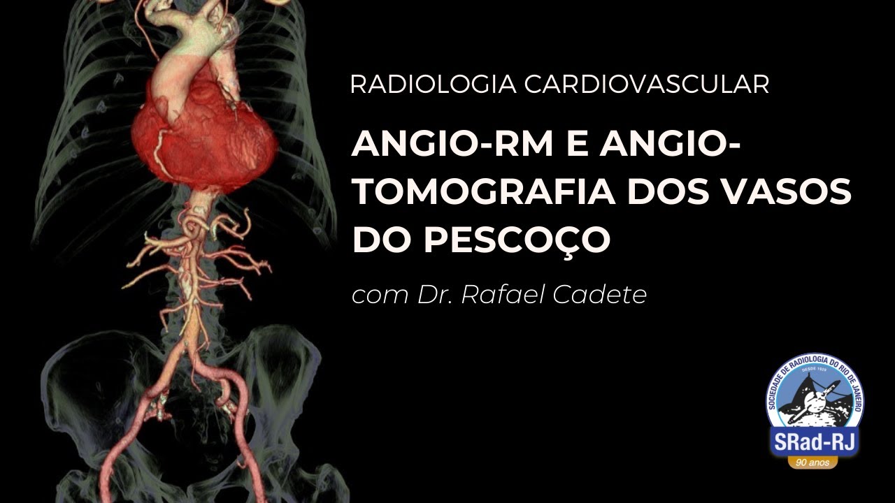 Angio-RM e Angio-tomografia dos vasos do pescoço - YouTube