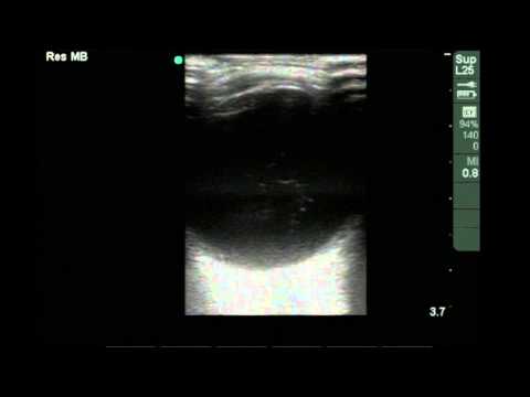 Ocular Ultrasound: Vitreous Hemorrhage
