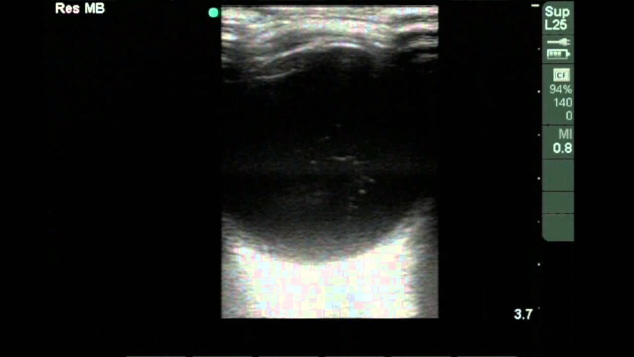 Ocular Ultrasound: Vitreous Hemorrhage - YouTube