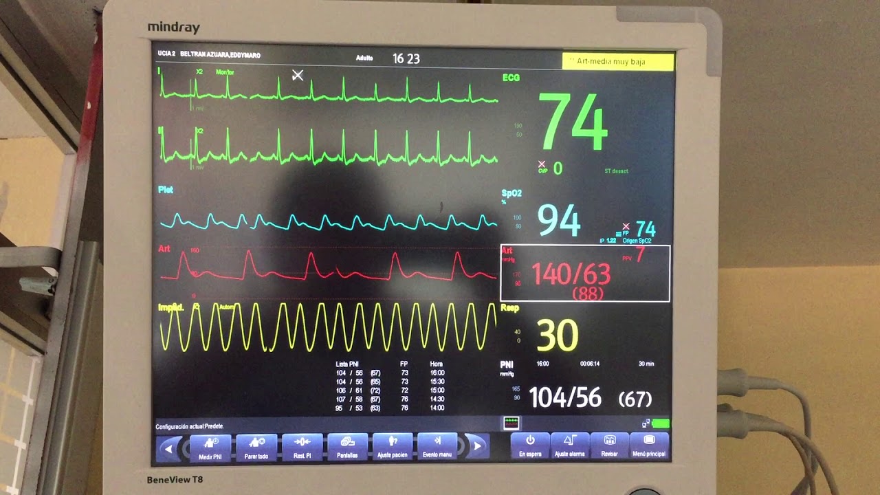 Monitoreo hemodinámico - YouTube