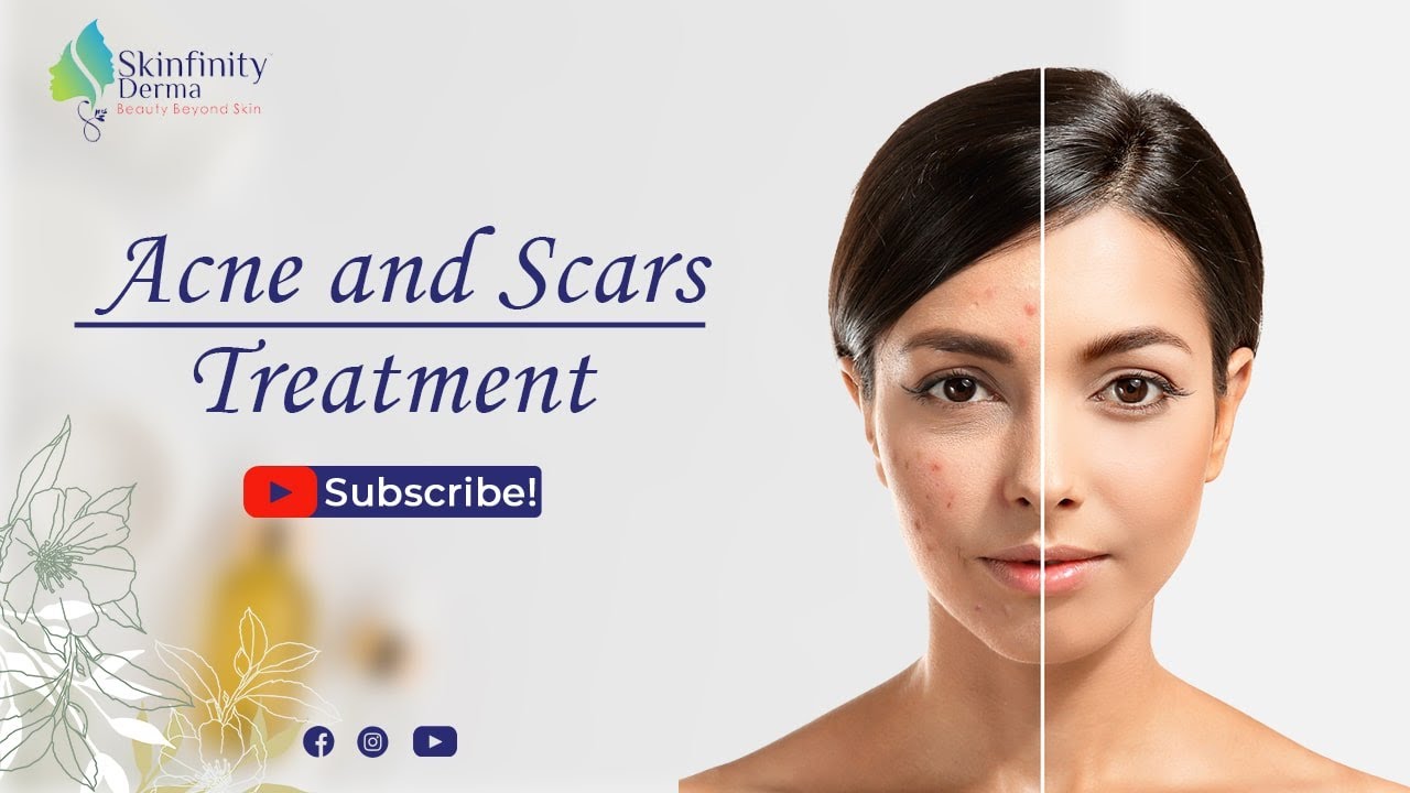 Acne and Scars Treatment || Best Acne and Scars Treatment in Noida ...