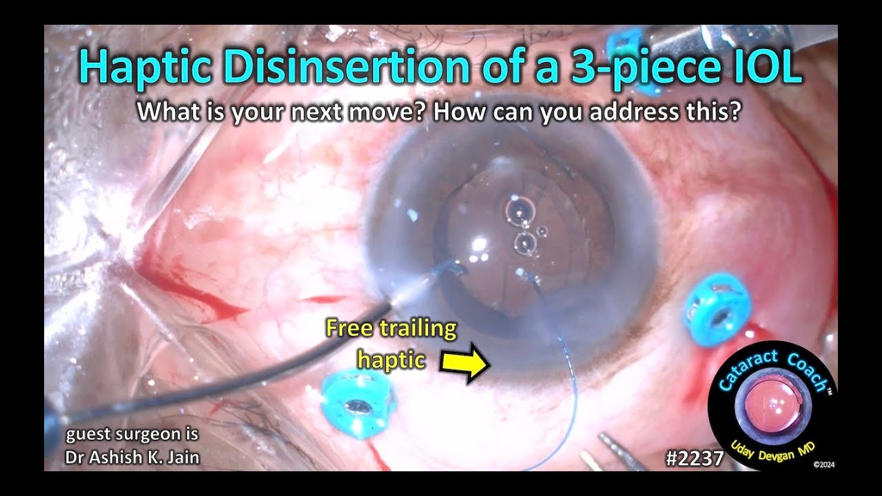 CataractCoach™ 2237: haptic disinsertion of a three-piece IOL - YouTube