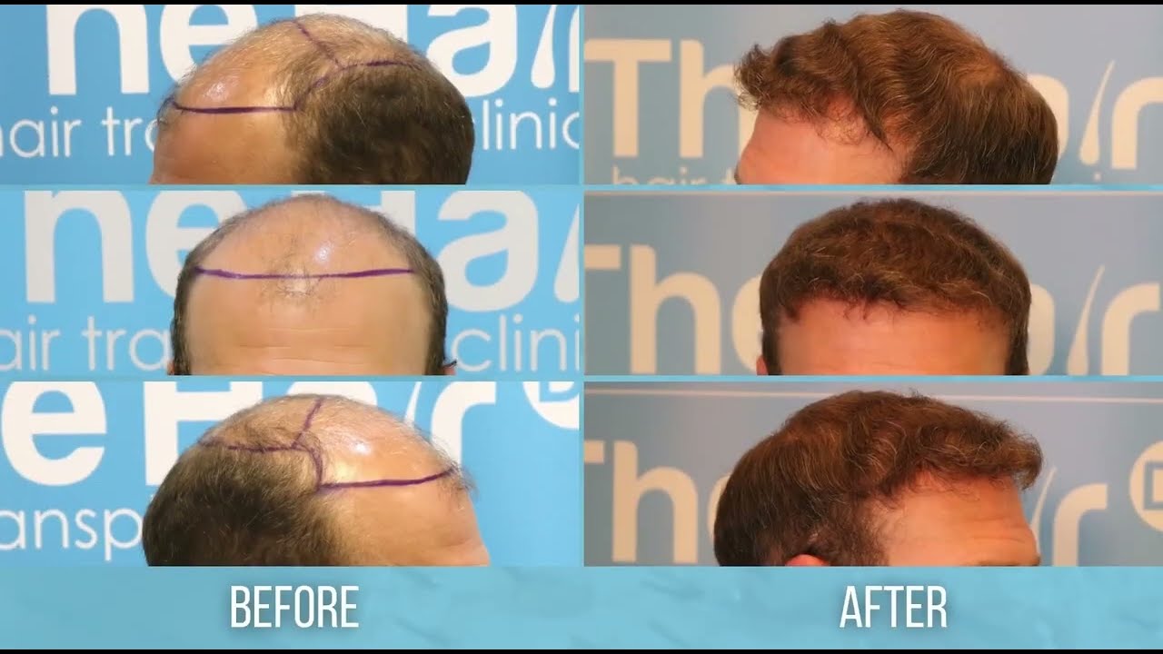 Sams Hair Transplant Journey By Dr Arshad Youtube