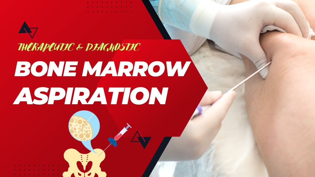 Bone Marrow Aspiration: Exploring a Diagnostic and Therapeutic ...