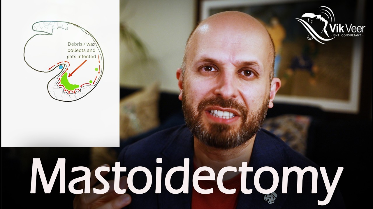 What is a Mastoidectomy (canal wall UP Vs Down} - YouTube