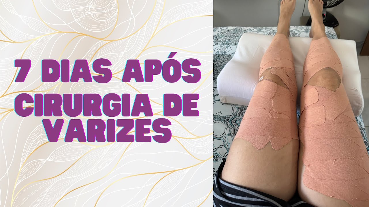 7 dias da minha cirurgia de varizes - YouTube