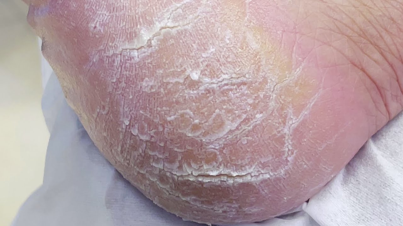 Too much dead skin on the heels, dry and cracked skin, how to deal with ...