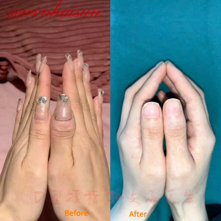 Stub thumb lengthening. #Toethumb #Doctor #Thumb #brachydactyly # ...