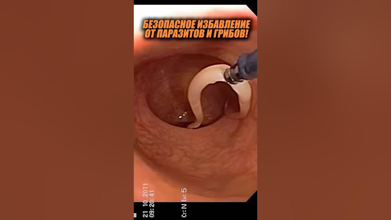 Глистогонка без таблеток в домашних условиях 🔥 - YouTube