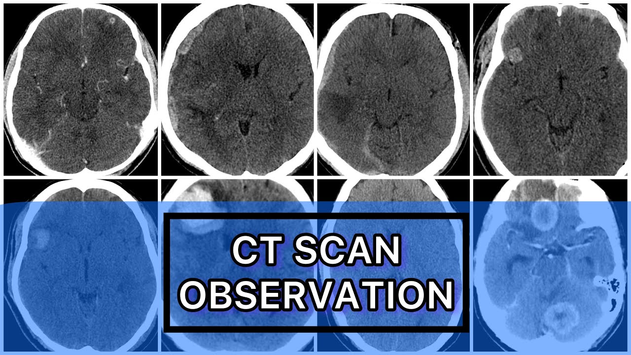 CT BRAIN OBSERVATION/IMPRESSIONS…#1#5 - YouTube