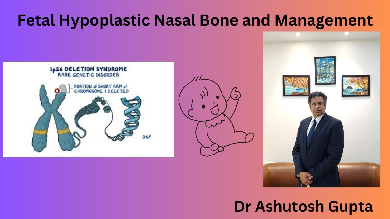 Fetal Hypoplastic Nasal Bone and Management - YouTube