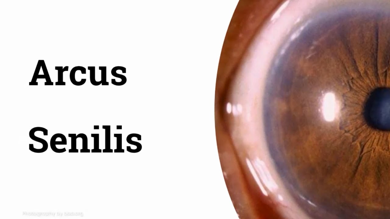 Arcus Senilis Brown Eyes